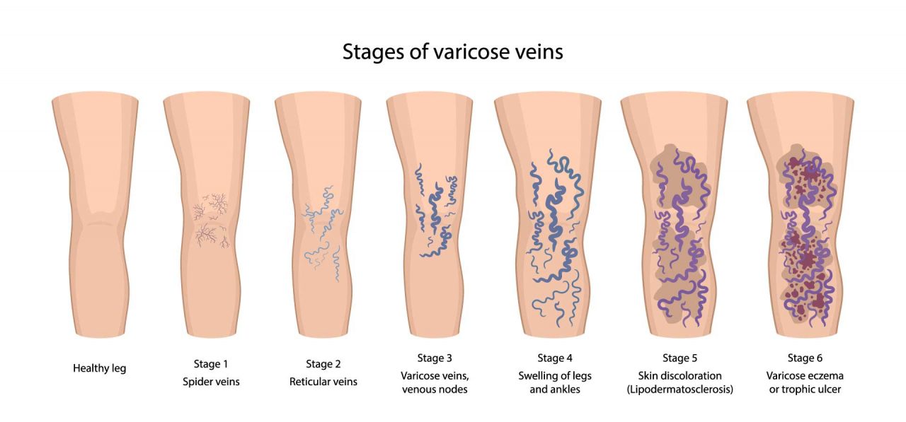 Varices | ACVEQ